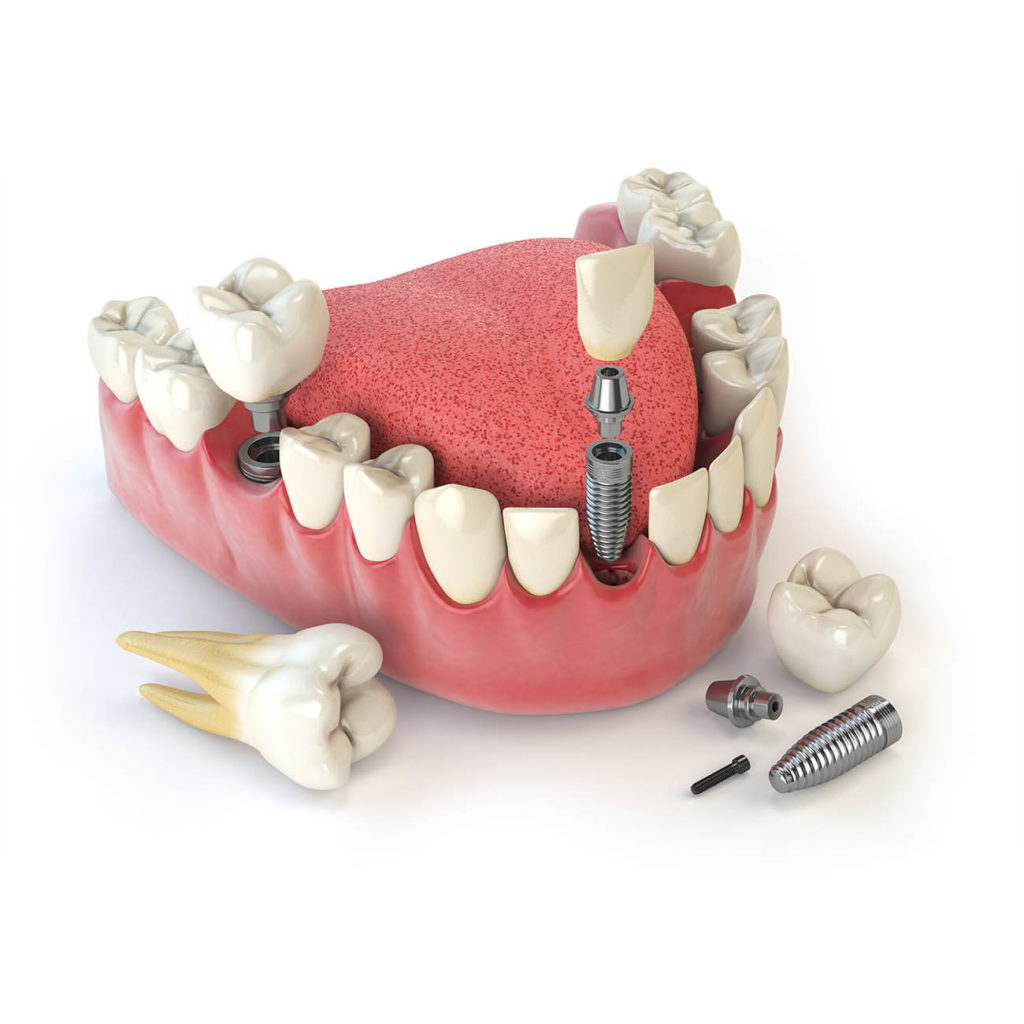 Dental Implants | Tooth Implant Procedure | Gleam Dentistry