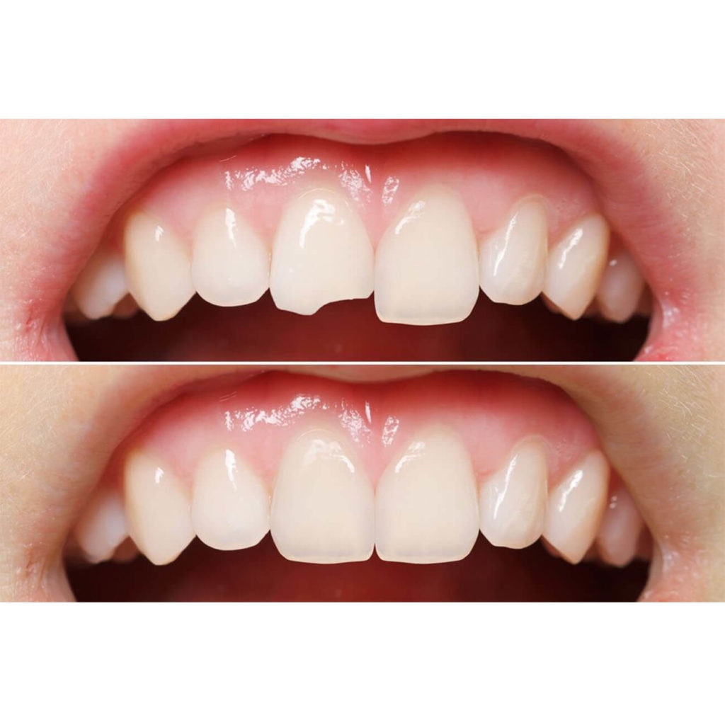 Cracked Teeth | Fix Broken Teeth | Gleam Dentistry